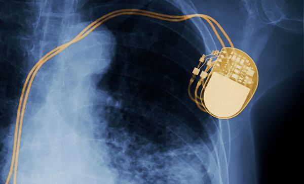 The benefits of implantable silicones for medical devices | Magazine